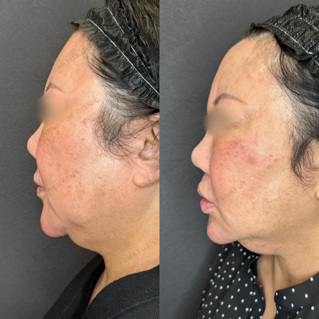 脂肪溶解小顔注射BNLS Fat Burn（ビーエヌエルエスファットバーン）最安1cc¥2,200 - レナトゥスクリニック【公式】東京/新宿/大阪/名古屋/仙台/福岡/富山の美容皮膚科・医療脱毛